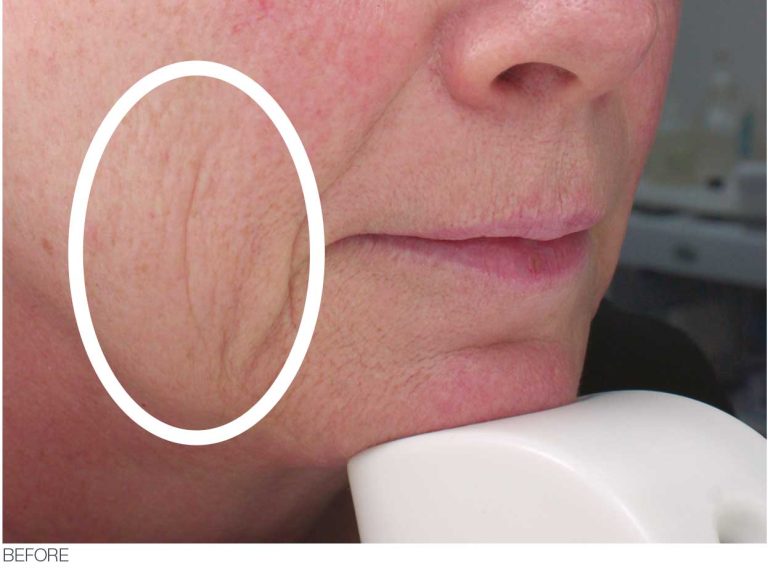 MPR Toroidal - Silhouet-Tone