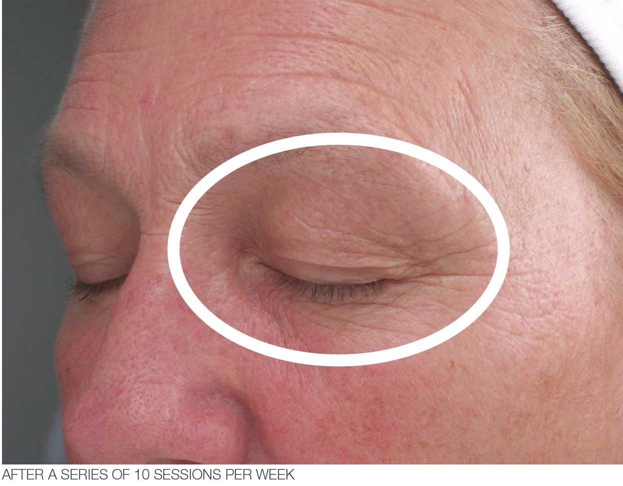 MPR Toroidal - Silhouet-Tone