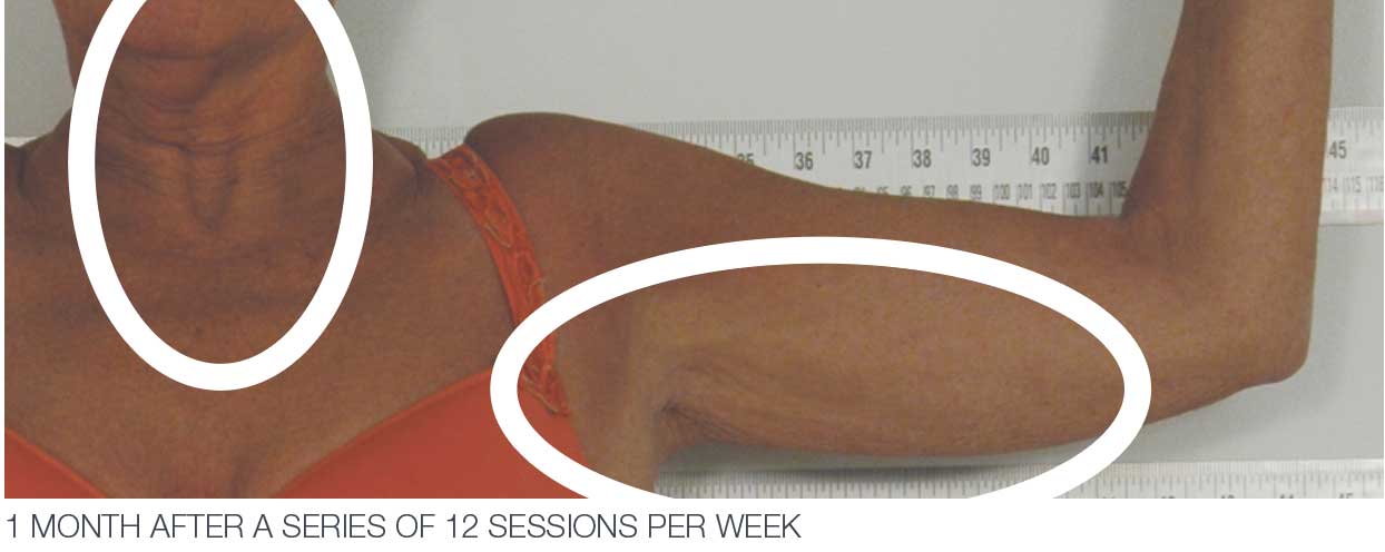 MPR Toroidal - Silhouet-Tone