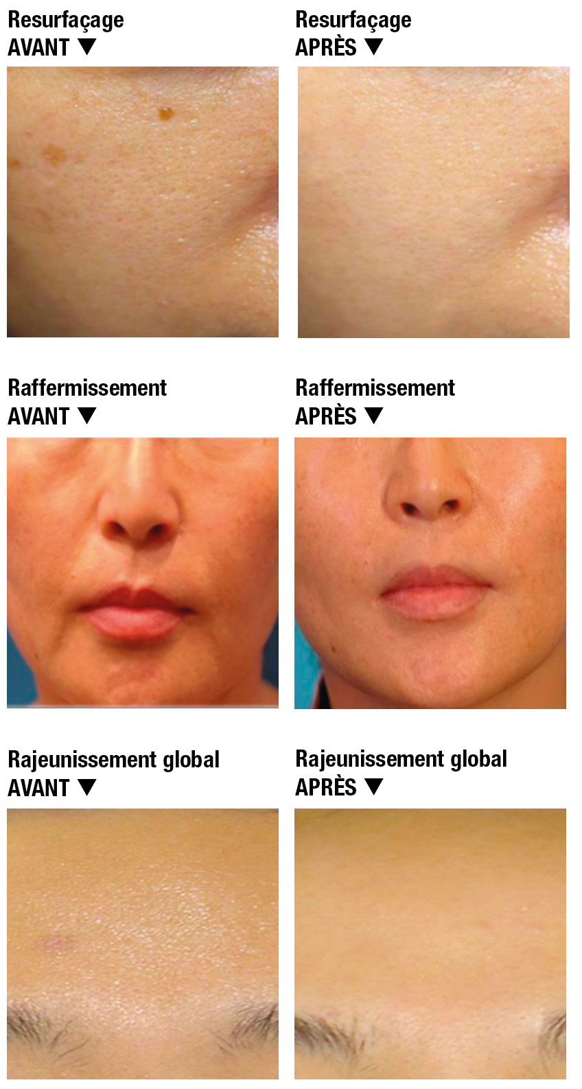 Body Shape RF - Silhouet-Tone